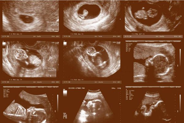 TYPES OF PREGNANCY SCANS – My Baby and I Scan
